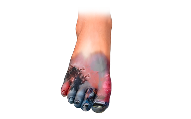 Gangrene Treatment: Symptoms, Causes & Care Explained