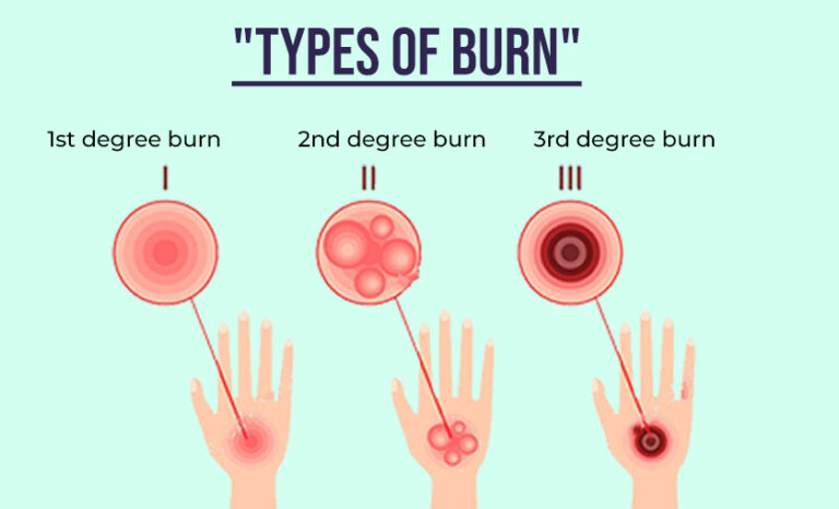 What to do when burn injuries take place? How to care for Burns.
