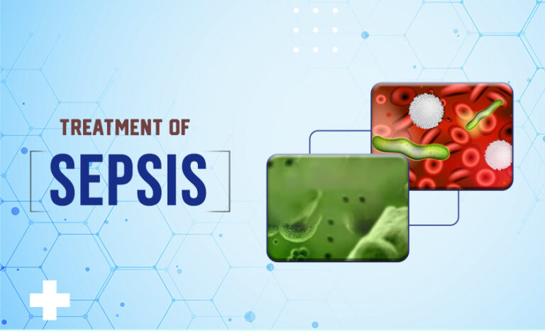 Do you know what Sepsis is? Best Treatment & Prevention ways.