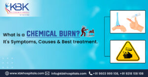 What is a Chemical Burn? Symptoms, Causes & Best Treatment.