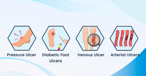 How to Identify Chronic Wound and Chronic Skin Ulcer