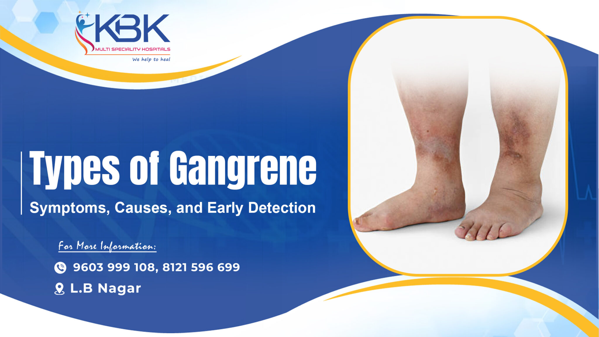 Types of Gangrene : Symptoms, Causes, and Early Detection