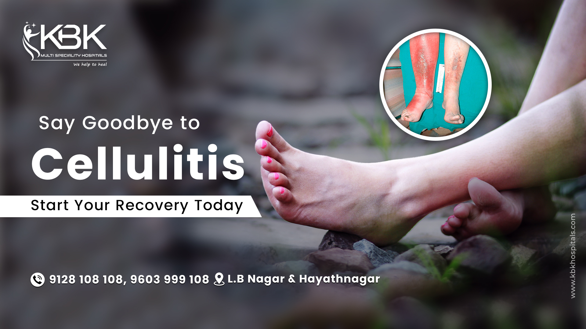 Treatment for Cellulitis – Effective Care for Fast Recovery