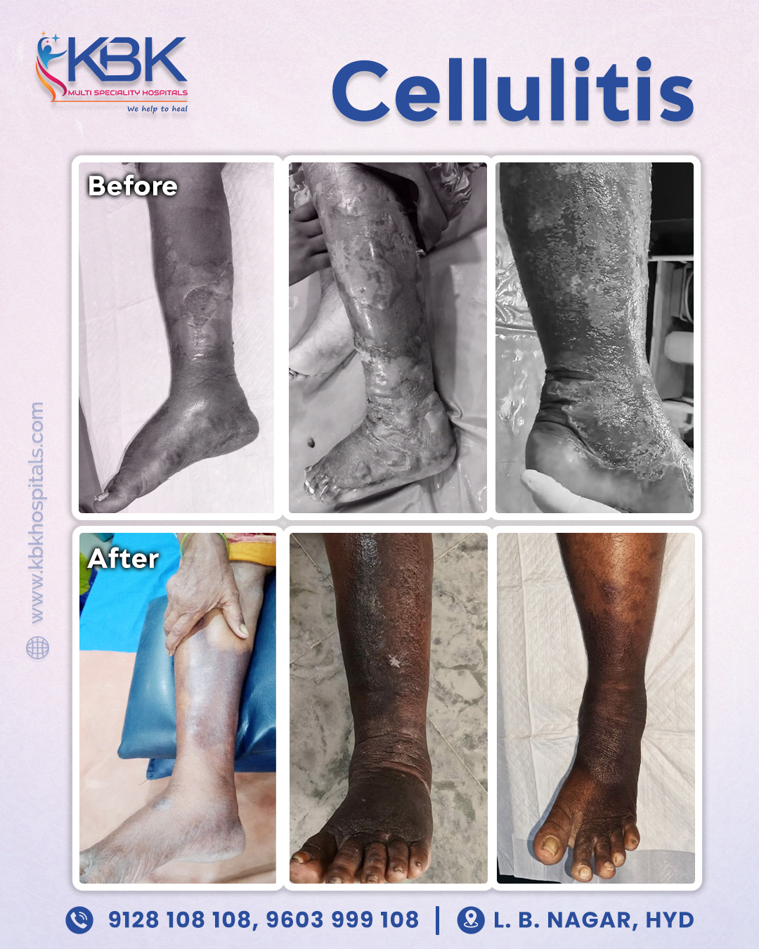 Treatment for Cellulitis – Effective Care for Fast Recovery