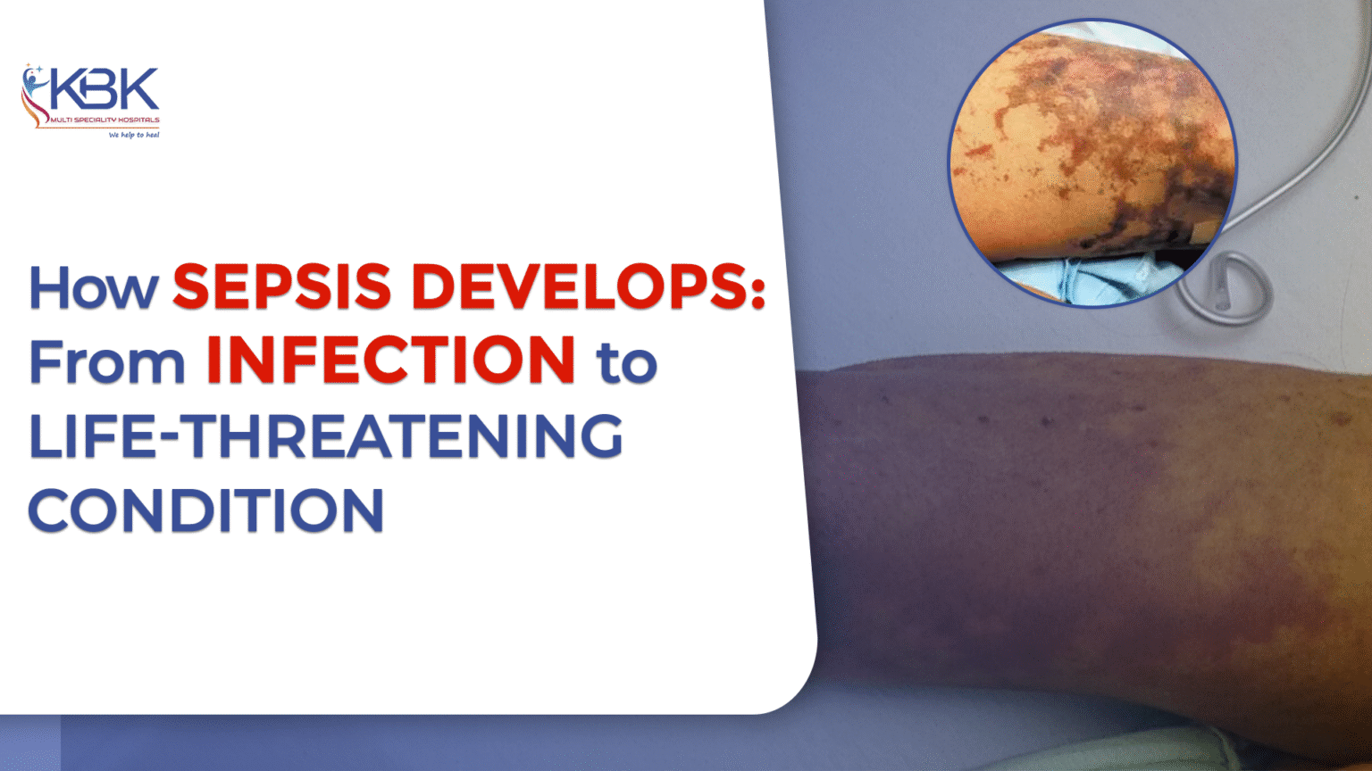 Sepsis: From Infection to Danger