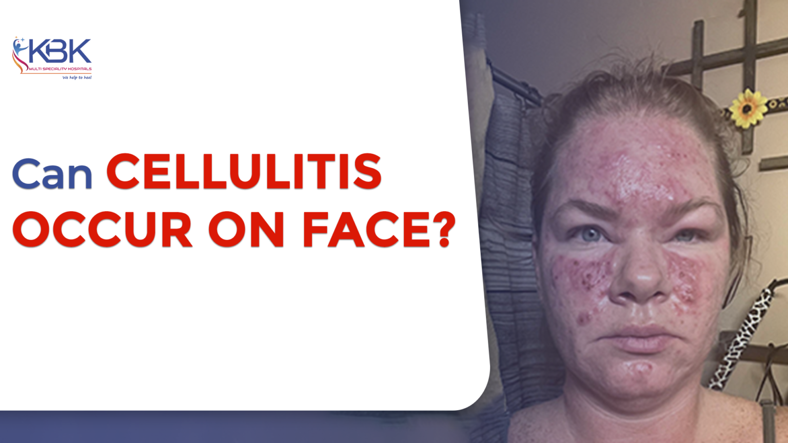 Cellulitis Infection: Signs, Causes & Care