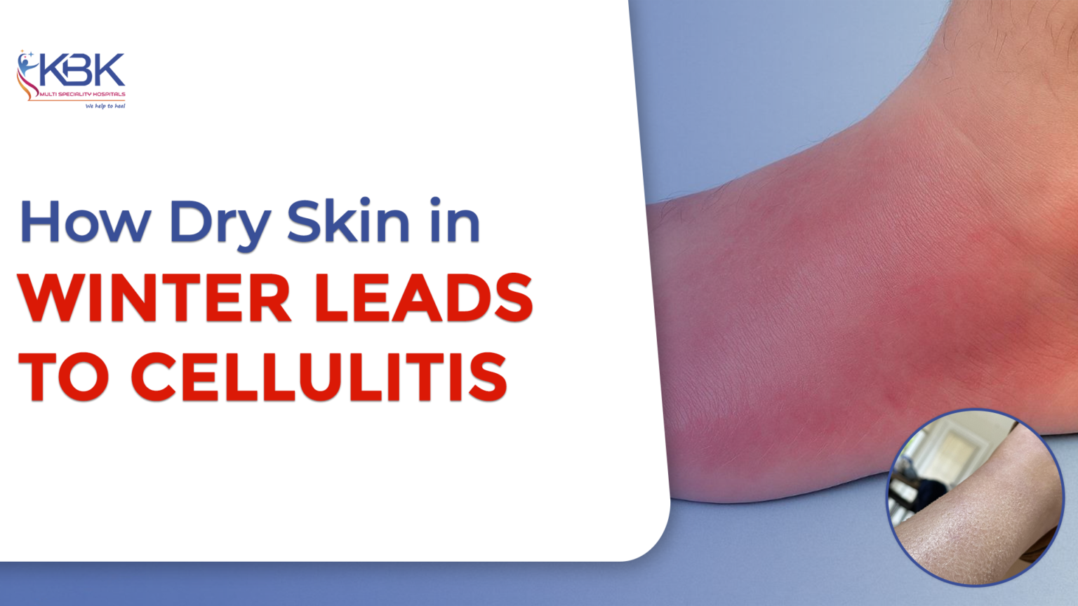 Dry Skin Causes, Symptoms & Winter Care Tips