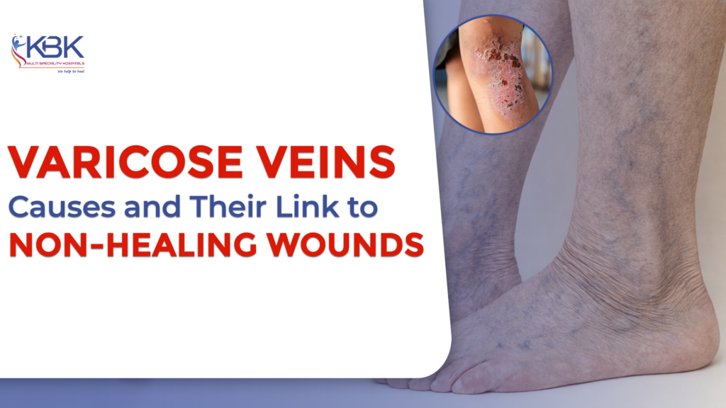 Varicose Veins Causes, Risks & Prevention