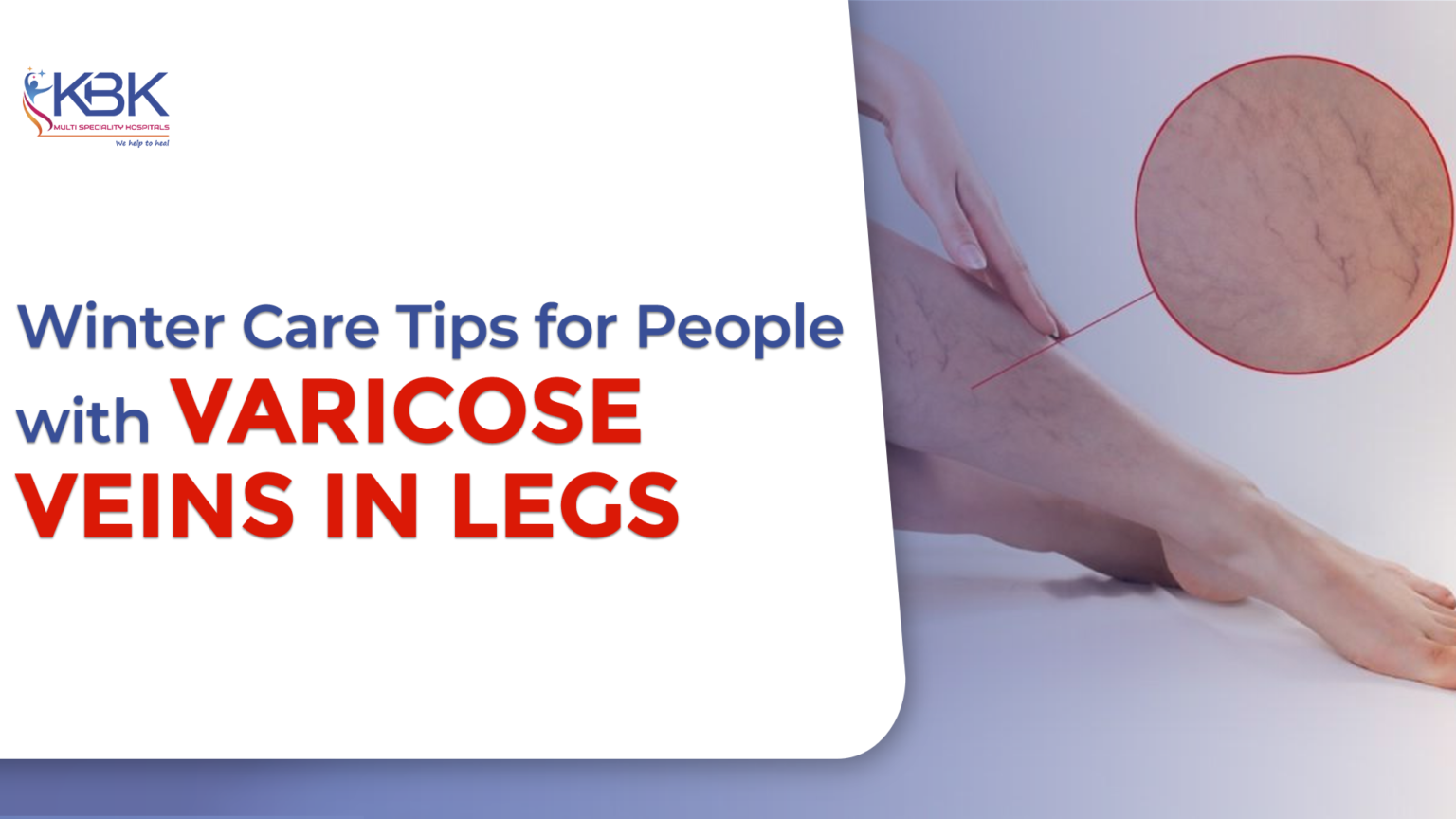 Varicose Veins in Legs: Symptoms & Care