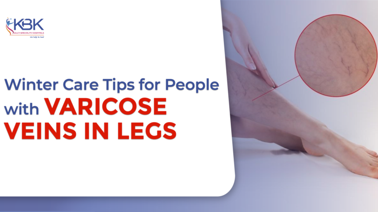 Varicose Veins in Legs: Symptoms & Care