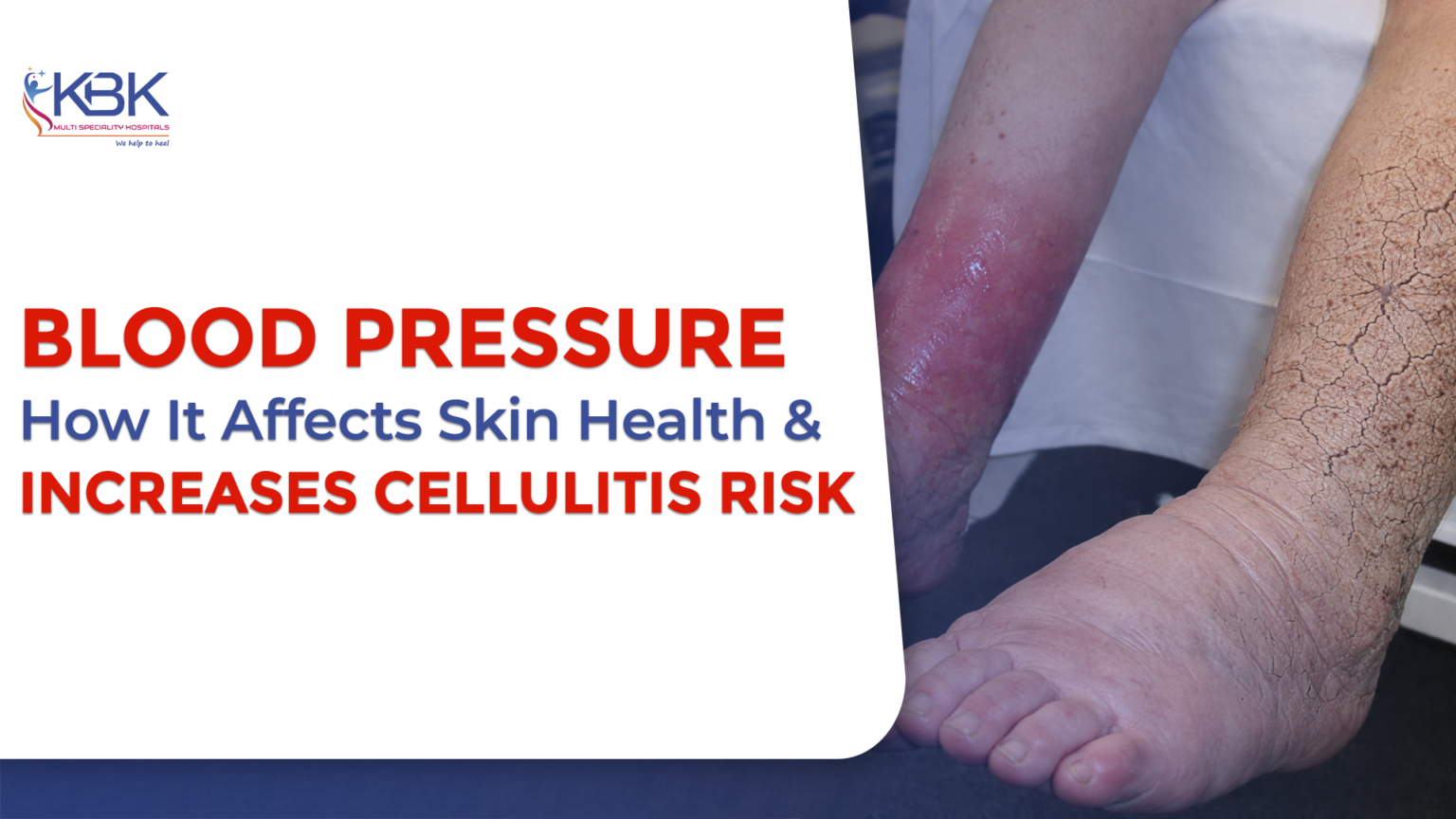 Cellulitis on Face: Symptoms & Treatment