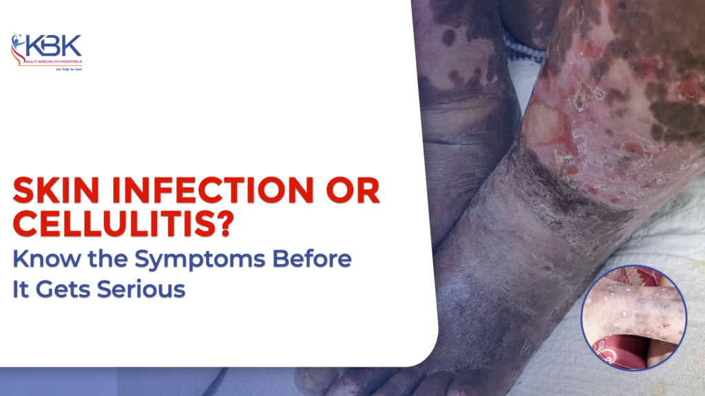 Staph Infection and Cellulitis : Know the Differences.