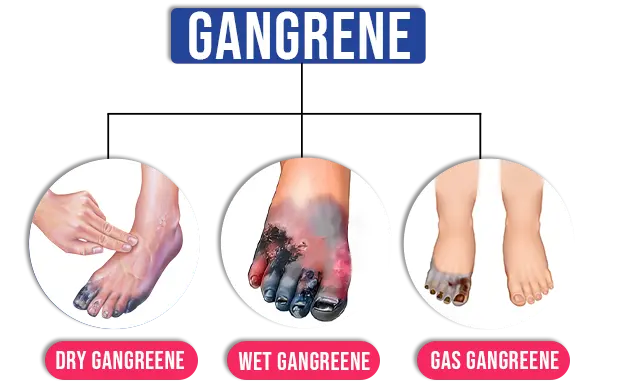 Gangrene Symptoms And Treatment